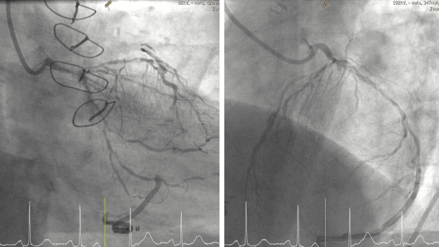 TAVI for a patient with small aortic annulus