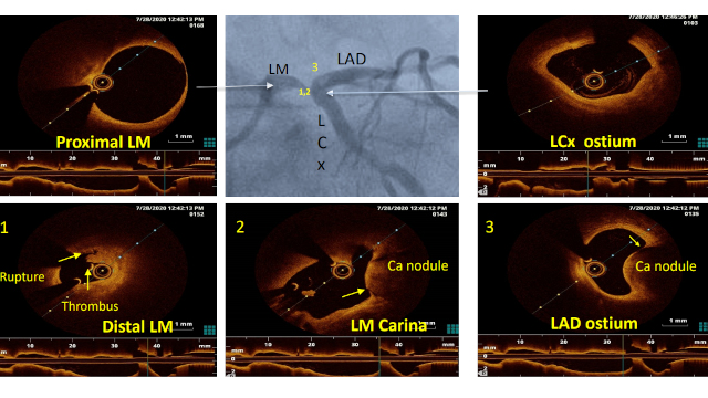 Acute coronary syndromes caused by left main coronary lesions requiring ...
