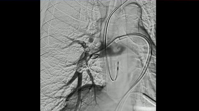 Advancing percutaneous treatment of pulmonary embolism with computer ...