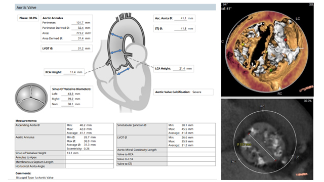 Complex TAVI procedures: bicuspid, large annulus, and pure regurgitation