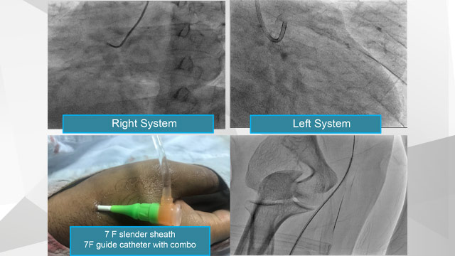 Complication occurring during PCI of calcified coronary lesions