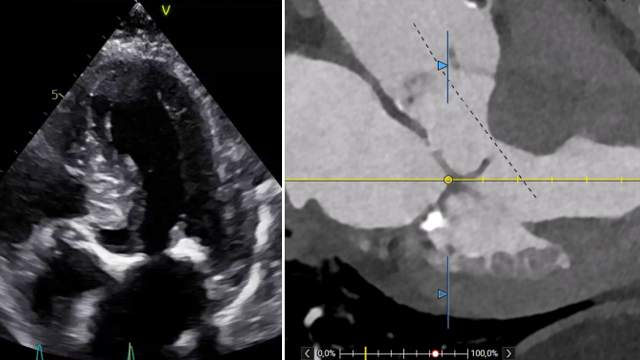 Contemporary TAVI cases: perspectives from three different continents