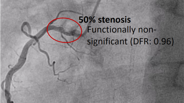 DCB PCI in restenosis and de novo lesions