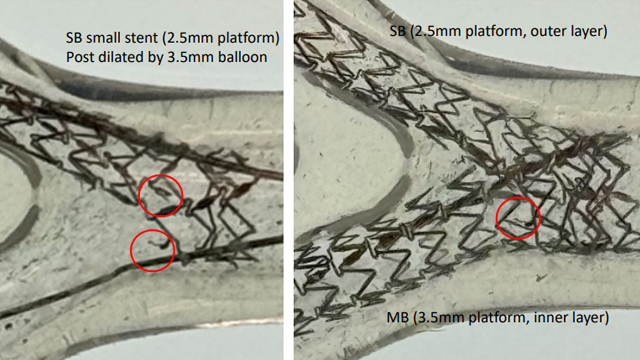 Drug coated balloon PCI in complex scenarios
