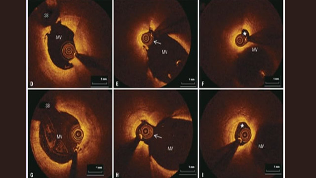 The ARC consensus on DCB - evidence-based DCB technology