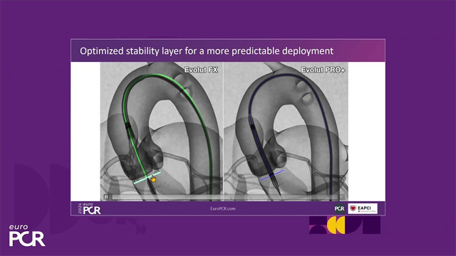 TAVI (Transcatheter aortic valve implantation)