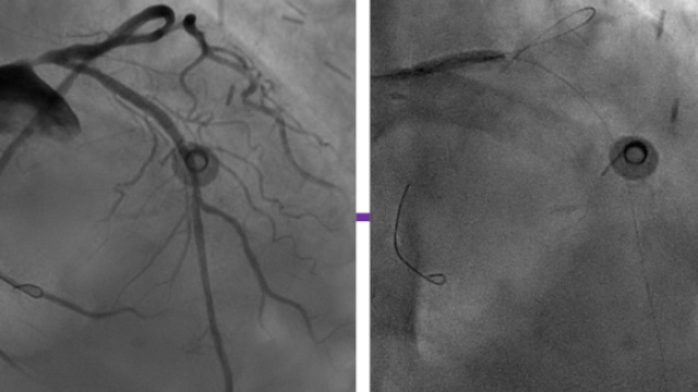 Heart team discussion for left main PCI