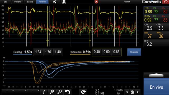 Imaging and physiology guided PCI