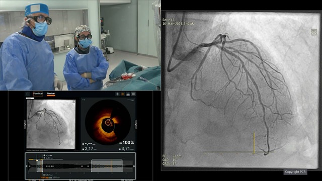 Imaging-guided PCI for stent failure - LIVE case