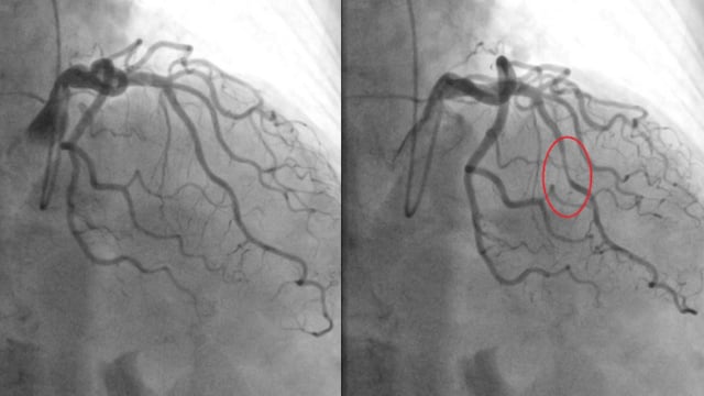 INOCA - MINOCA and nonatherosclerotic coronary artery disease