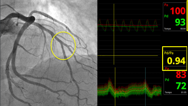 Intracoronary imaging: PCI guidance