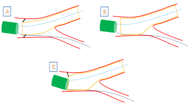 Left main bifurcation techniques - Part 1