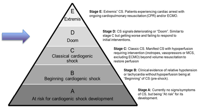 Management of ACS patient with cardiogenic shock