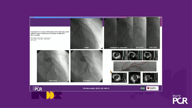 Mastering the future of PCI with drug-coated balloons