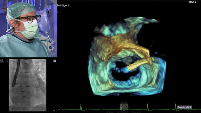 TEER for primary mitral regurgitation - LIVE case