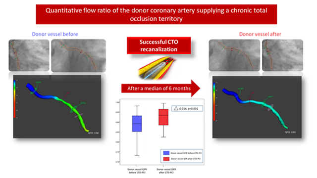 Comparative insights into QFR, FFR, and angiography