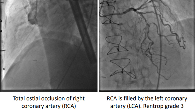 NSTEMI in patients in post CABG: a challenging combination