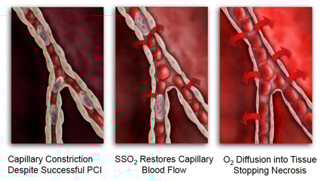 Other coronary interventions: SSO2, angioPy & more