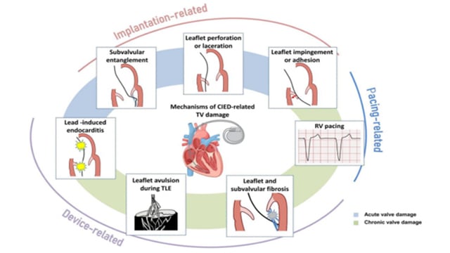 Pacemaker lead and the tricuspid valve: navigating challenges for ...