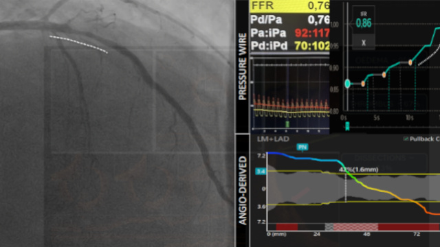 PCI: complex procedures