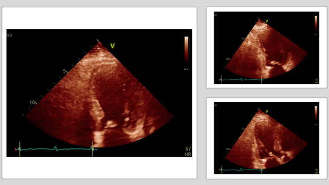 PCI complications: stay vigilant to prevent, recognise and manage