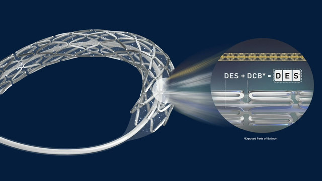 PCI in patients with diabetes: next generation DES + DCB stent platform ...