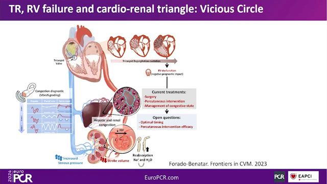 Percutaneous tricuspid treatment in challenging anatomies