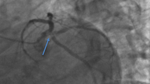 Primary PCI in different situations