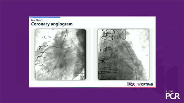 Relief for the unrelievable: the role of the Reducer for refractory angina