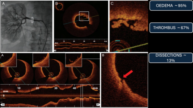 Renal denervation step by step: how to perform a safe and effective ...