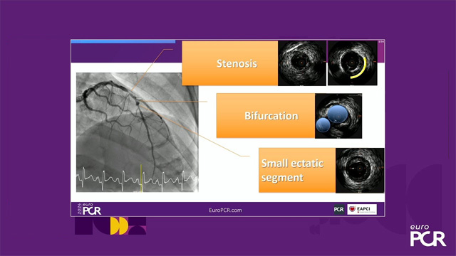 Restoring vessel physiology drives outcomes - The Bioadaptor experience