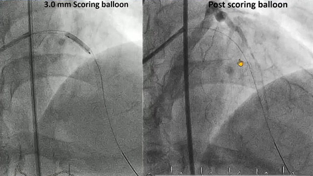 Sirolimus-coated balloon: expanding the scope of indications for ...