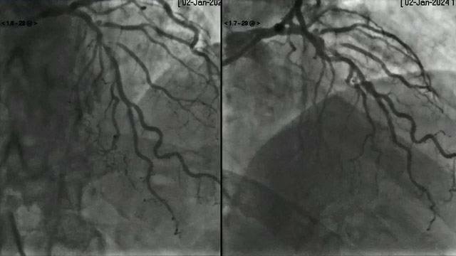Sirolimus-coated balloon: exploring the case- and clinical-based evidences