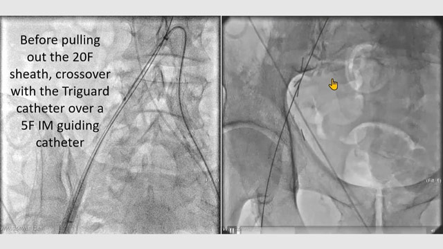 TAVI in challenging anatomies