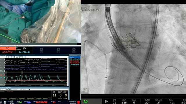 TAVI (Transcatheter aortic valve implantation)