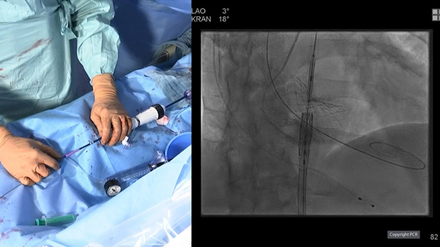 TAVI in TAVI - LIVE case