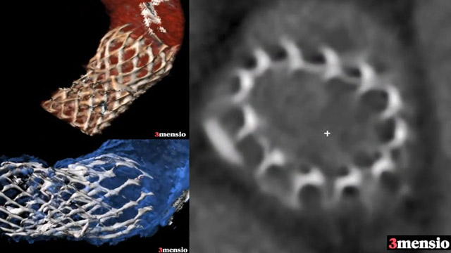 TAVI Hotline: new devices, new approaches