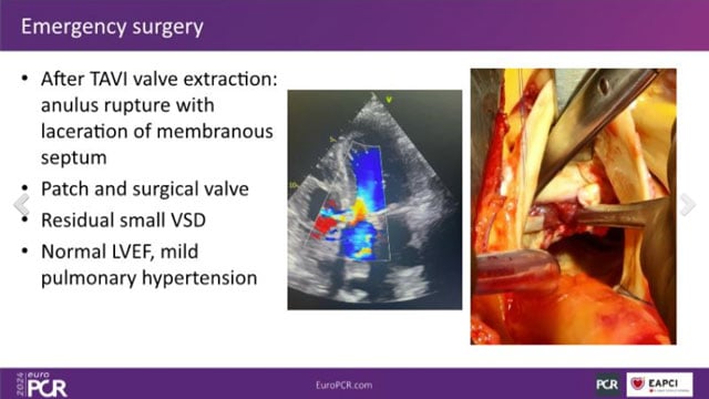 TAVI: managing acute procedural complications