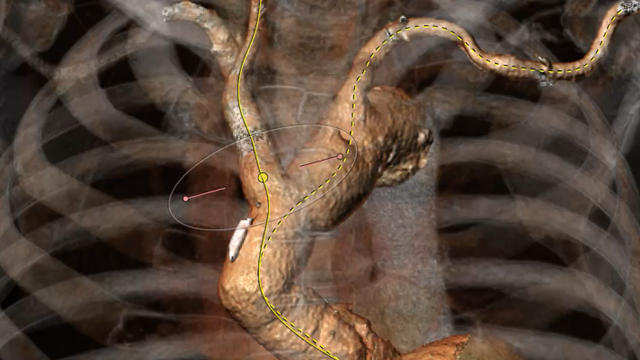 TAVR in challenging anatomies