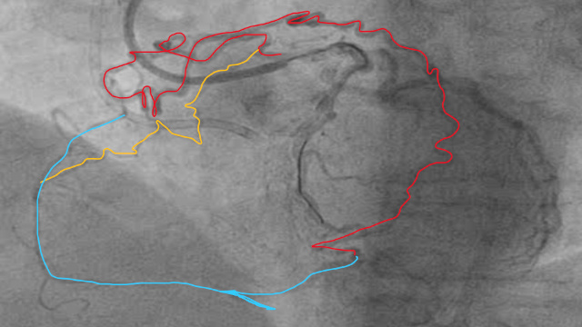 Technical pearls in CTO PCI