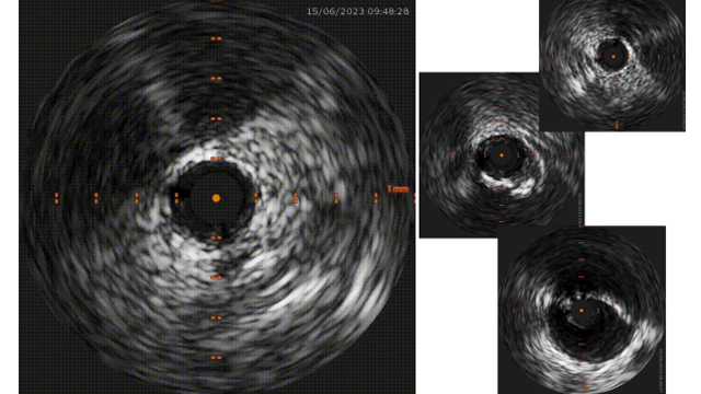 The value of IVUS during CTO PCI