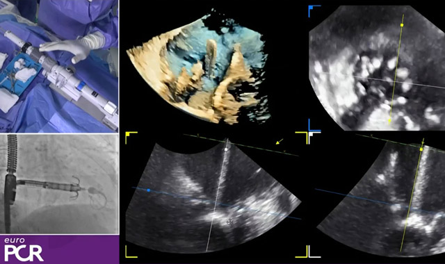 Transcatheter tricuspid valve replacement - LIVE case