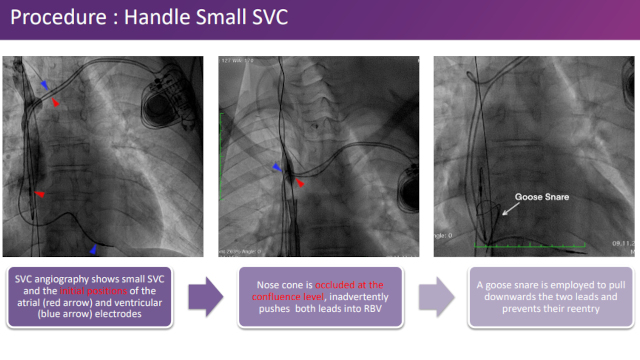 Treating the right valves: not always a straightforward task
