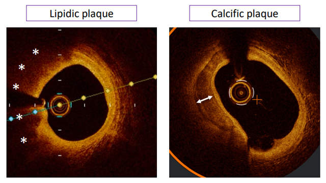 Vulnerable plaque identification and treatment