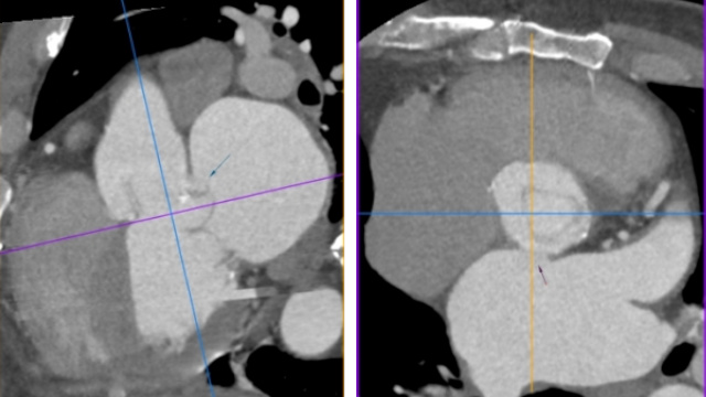 When and how to plug holes in the cathlab
