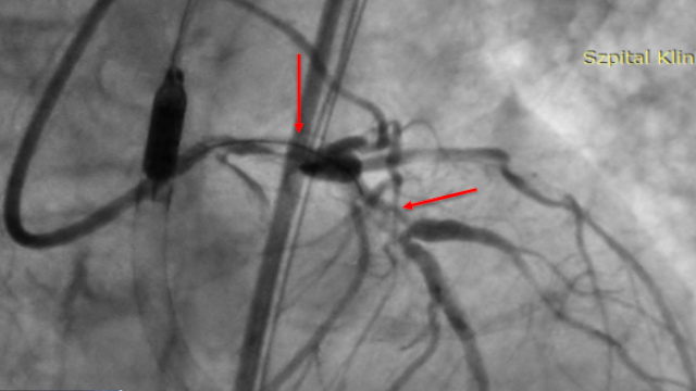When using left ventricular support during PCI