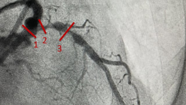 Caught between a calcified rock and a hard place