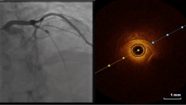 IVUS and OCT from the NAPs' perspectives