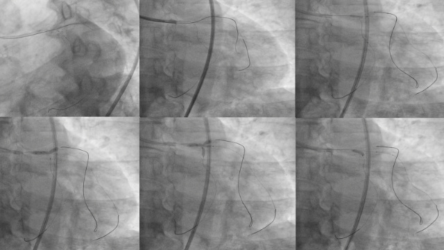 Left main PCI strategies for bifurcations and trifurcations