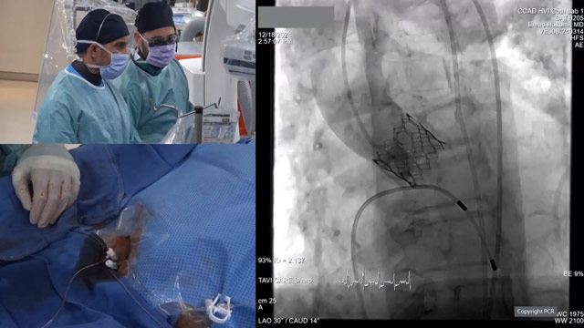 TAVI in complex situation - LIVE case